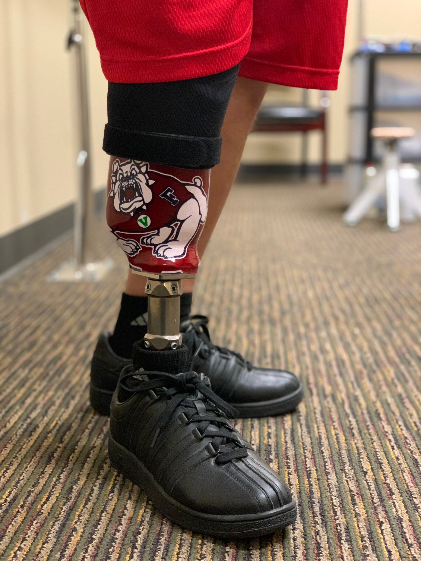 Glacier Point Prosthetics – A Capstone Orthopedic Company